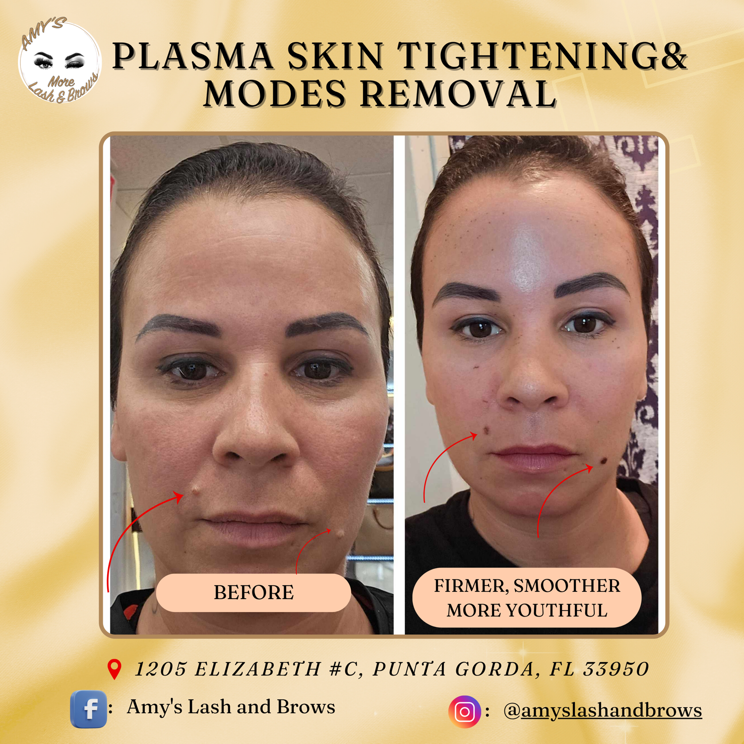 Plasma Fibroblast Skin Tightening – Non-Surgical Facelift in Punta Gorda