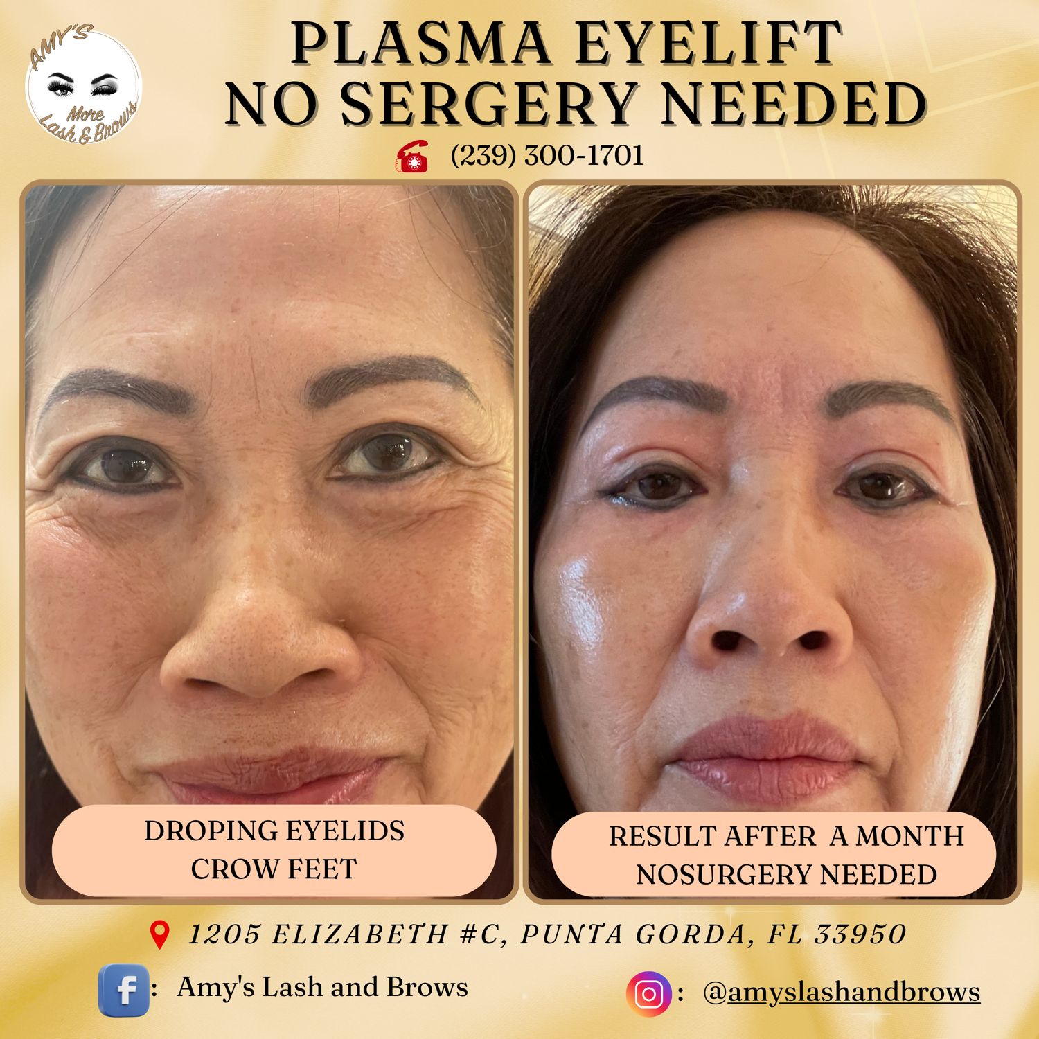 Plasma Eyelid Lift in Punta Gorda | Non-Surgical Eye