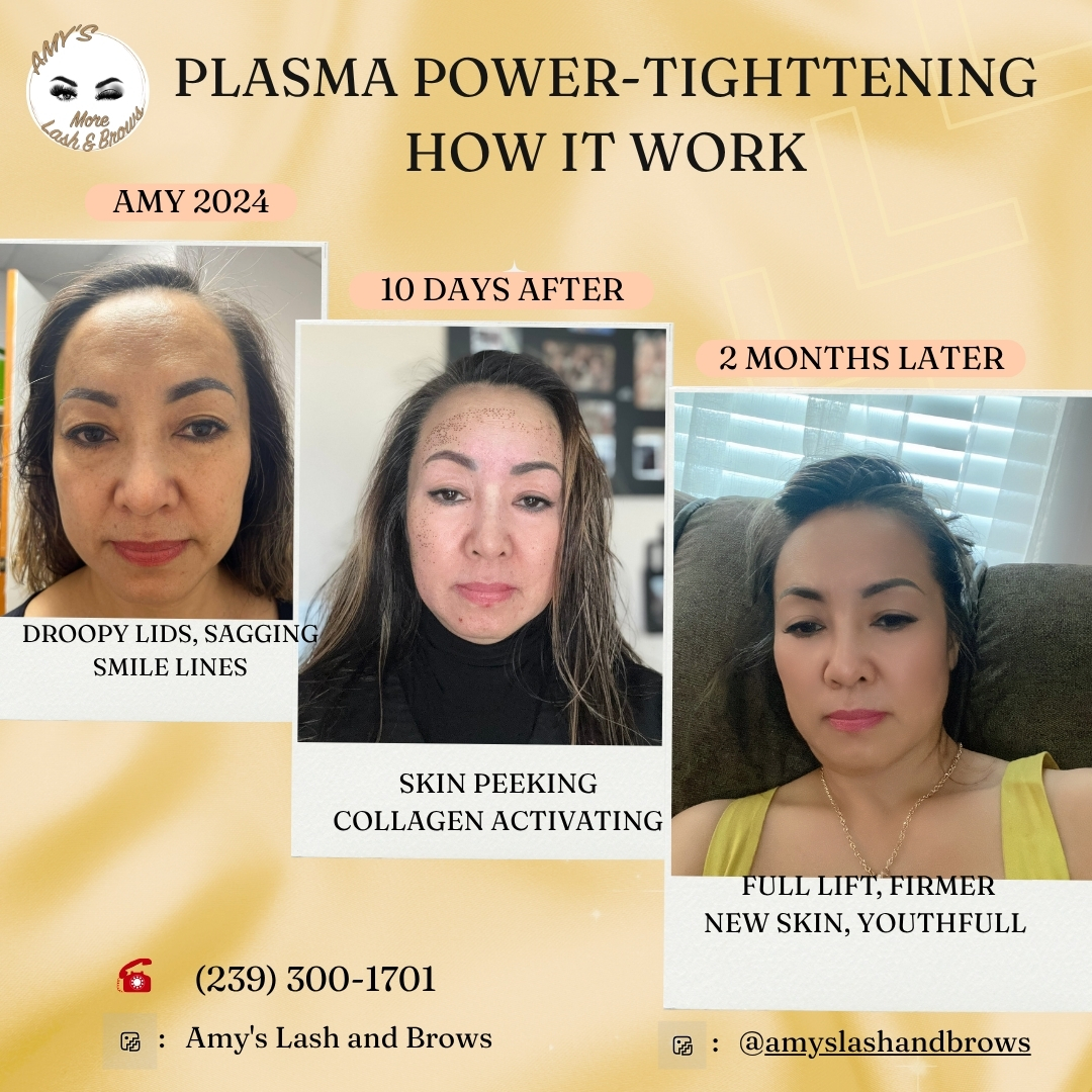 Plasma Skin Tightening for Full Face – Non-Surgical